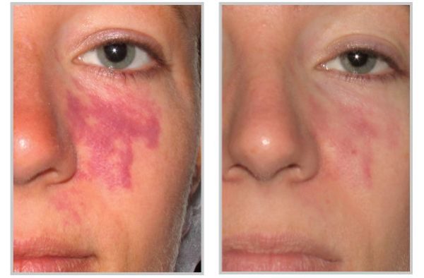 Intense Pulsed Light - Skin Secrets