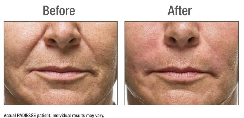 RADIESSE® - Skin Secrets