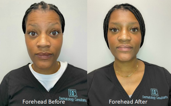 Dysport® - Skin Secrets