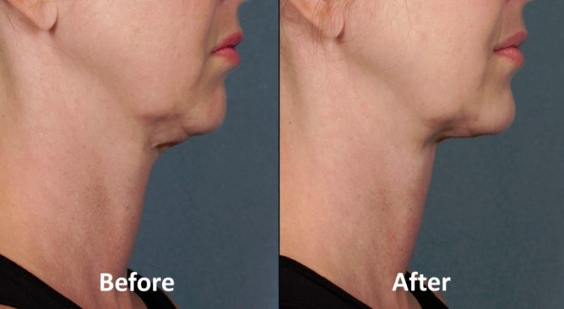 KYBELLA® - Skin Secrets