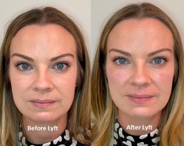 Restylane Lyft® - Skin Secrets